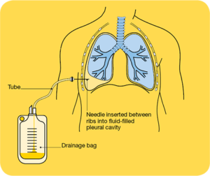 Pleural Tapping | Thoracocentesis | Dr Parthiv Shah